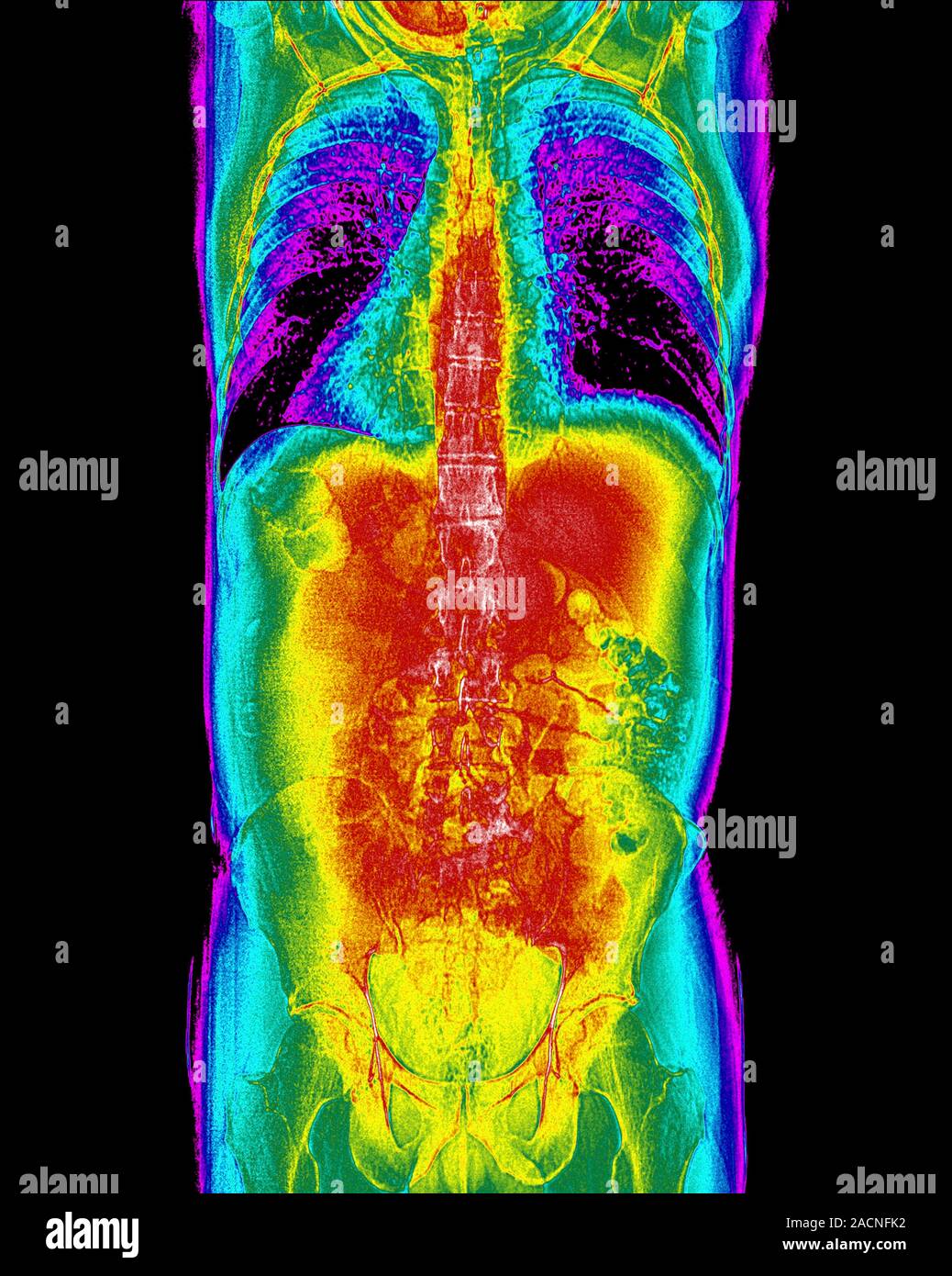 Normal human torso, coloured frontal magnetic resonance imaging (MRI ...