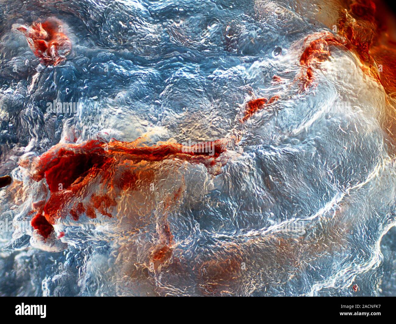 Skin lesion. Light micrograph with dark field illumination, showing a ...