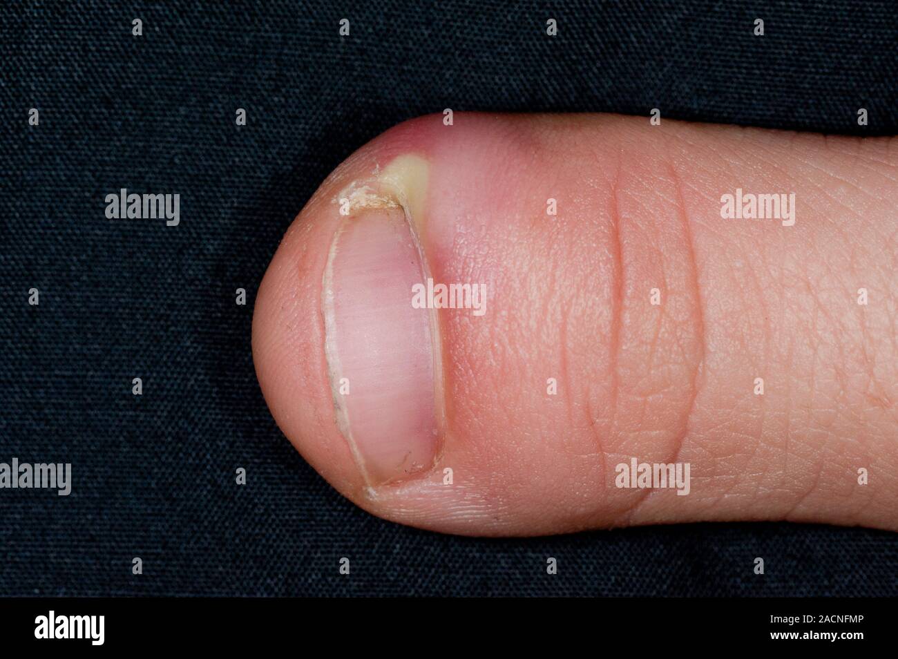 Close-up of pus under the skin from an infection around the fingernail ...