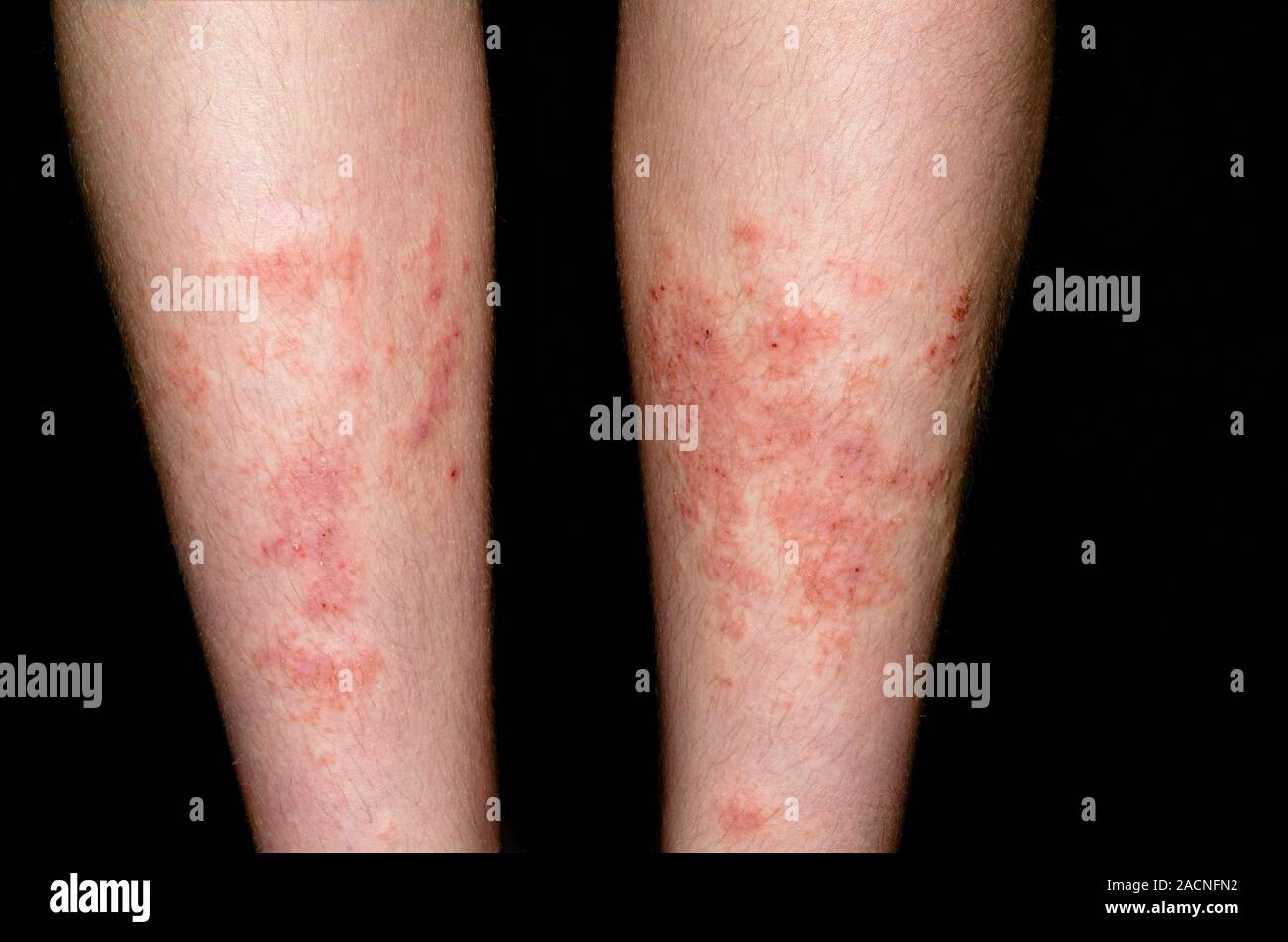 Red rash on the shins of the legs in an 11 year old male patient due to ...