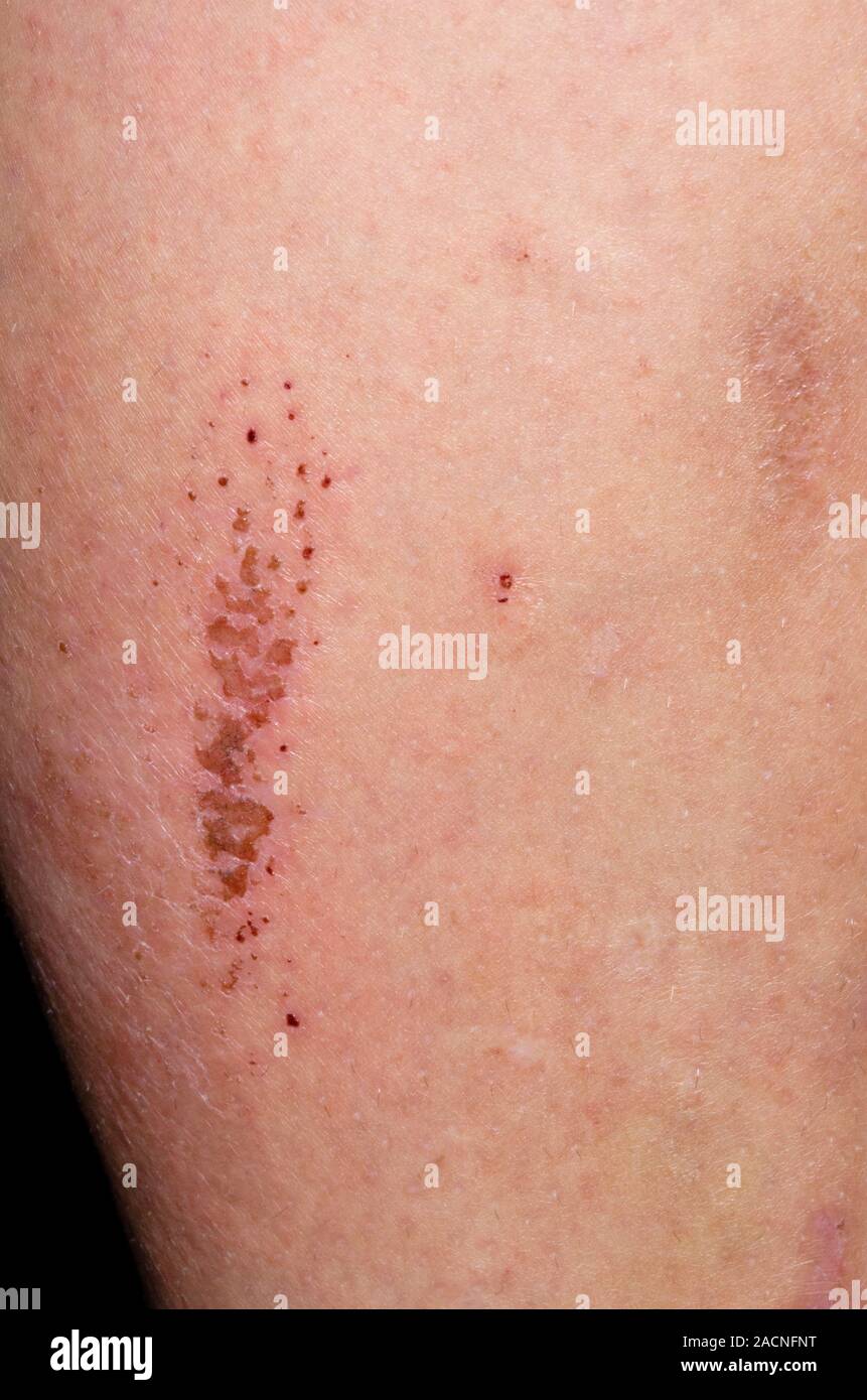 Red rash and scabbed sores on the shin of the leg in a 16 year old ...