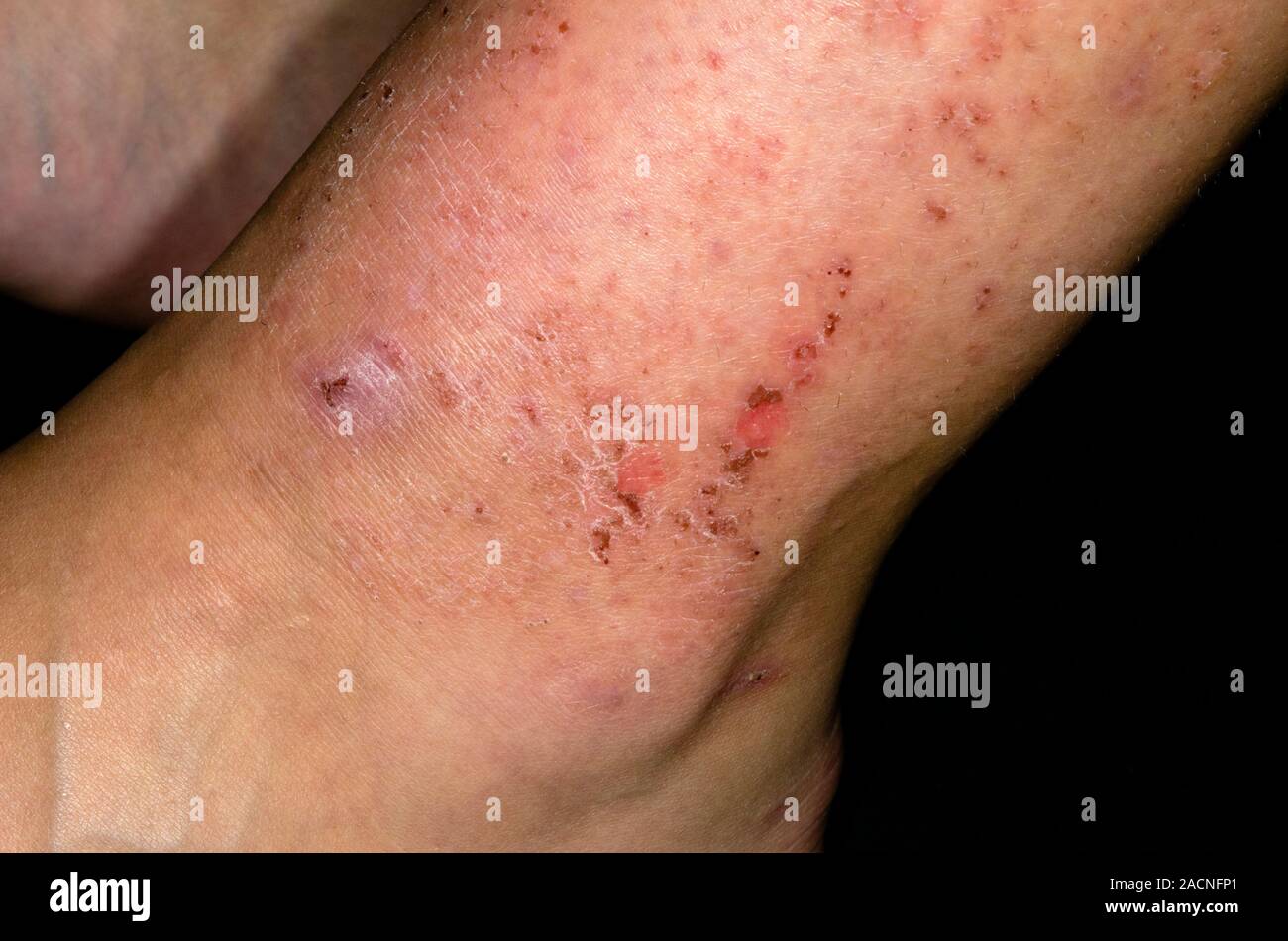 Red rash and scabbed sores on the shin of the leg in a 16 year old ...