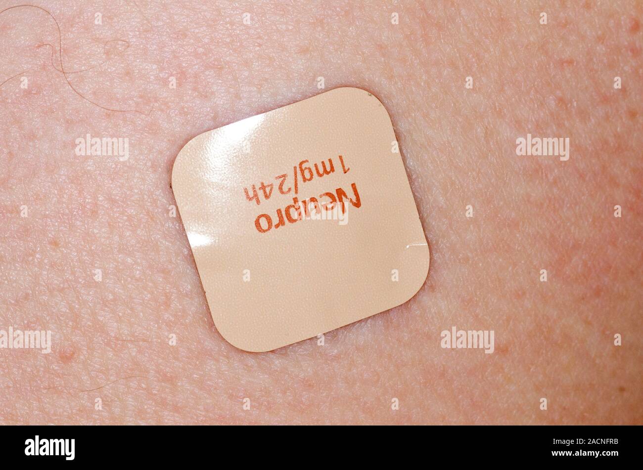 Neupro (Rotigotine) patch on the skin in a 75 year old male patient ...