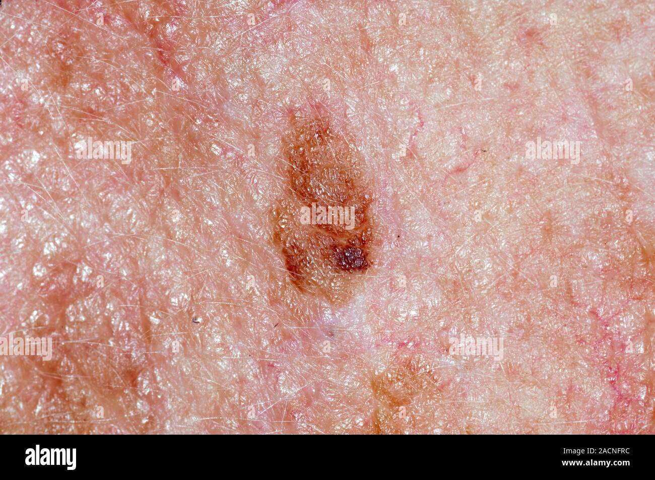 Close-up of a pigmented seborrhoeic wart (keratosis) on the skin in a ...