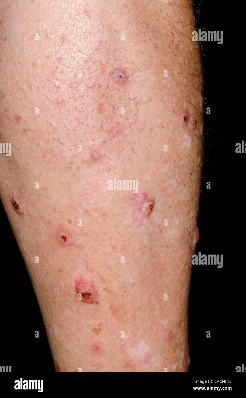 Dark nodules on the skin of the leg in an 84 year old male patient, a ...