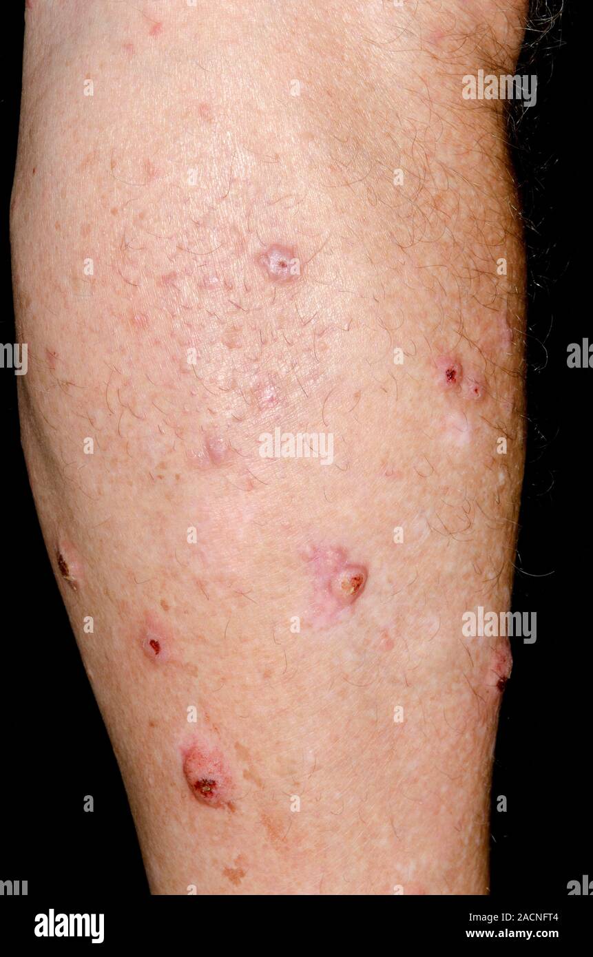 Dark nodules on the skin of the leg in an 84 year old male patient, a ...
