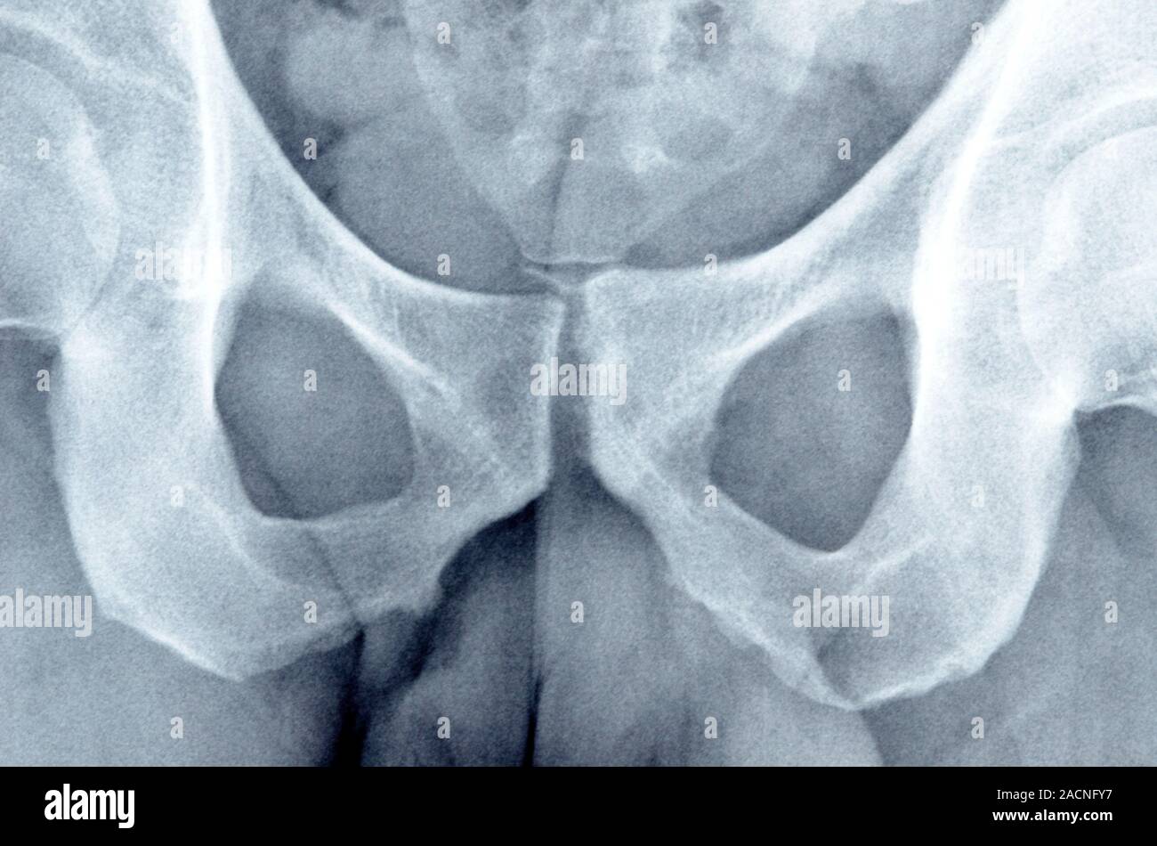 X-ray (front view) of the pelvic bones in a 45 year old male patient whose pubic symphysis (at ...