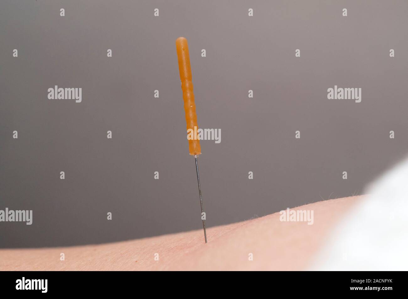 Acupuncture needle inserted into the skin in an adult female patient ...