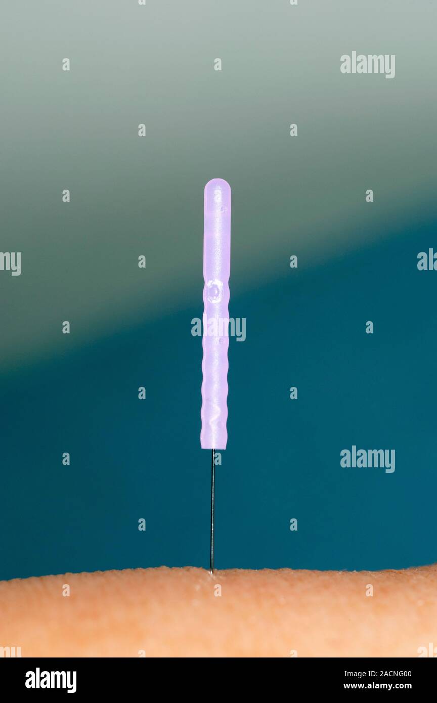 Acupuncture needle inserted into the skin in an adult female patient ...