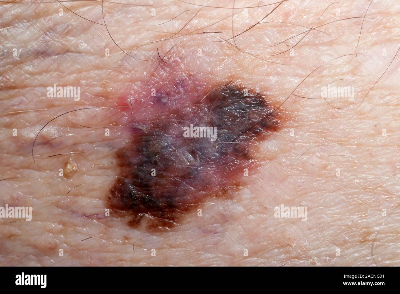 Close Up Of Skin Cancer A Superficial Spreading Melanoma Ssm On The Thigh In An 84 Year Old