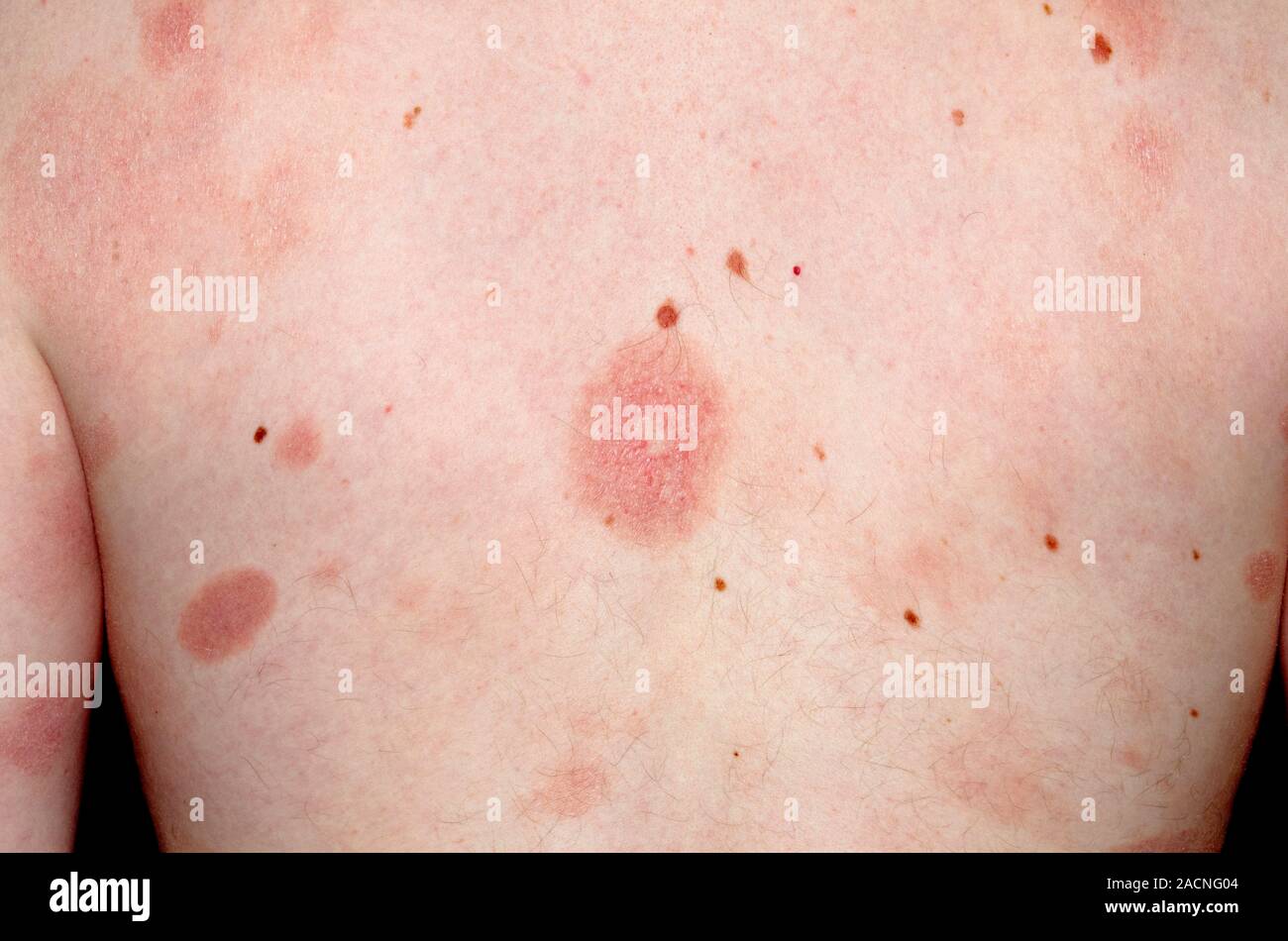 Close-up of red patches on the skin of the back in a 33 year old male ...
