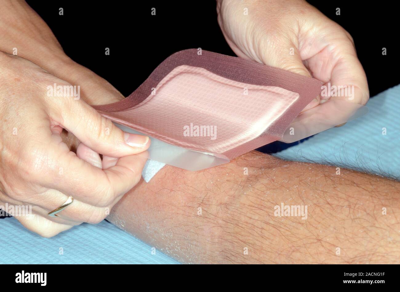 Gloved hands place a dressing on an infected laceration (irregular ...