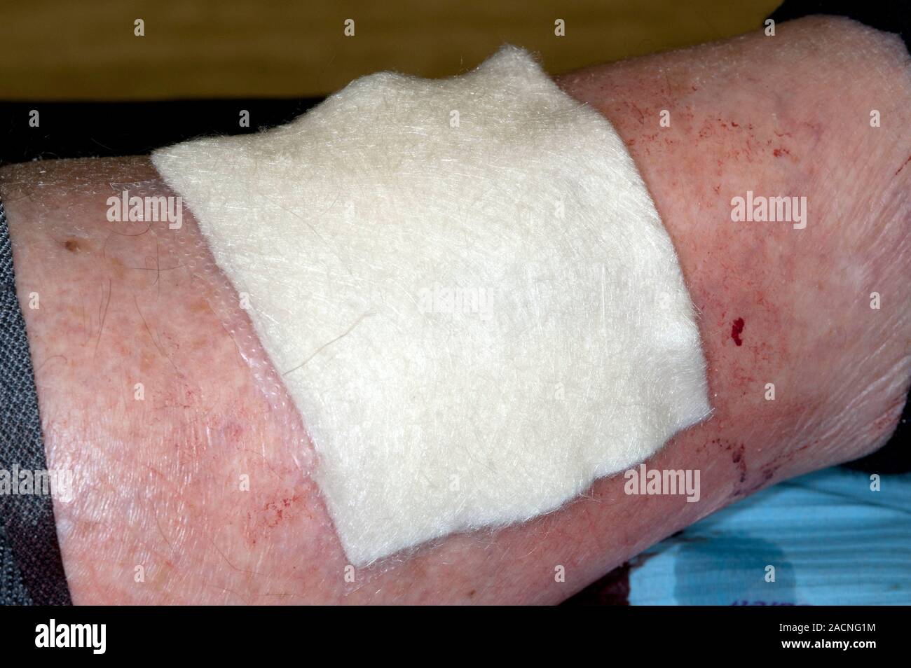 Gauze dressing placed over a laceration (irregular wound) to the skin ...