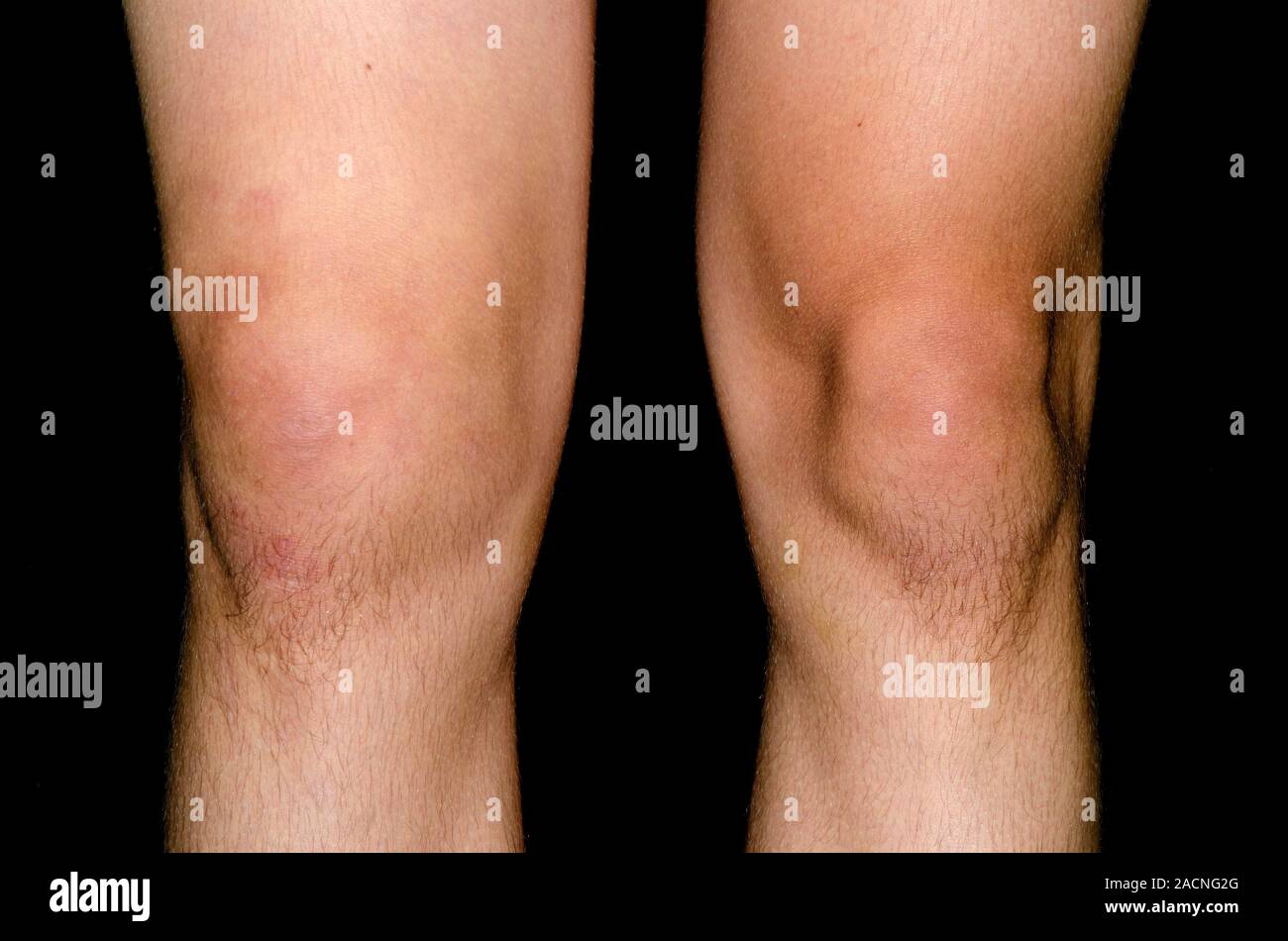 Inflamed knee (at left) due to a fractured leg bone (posterolateral ...