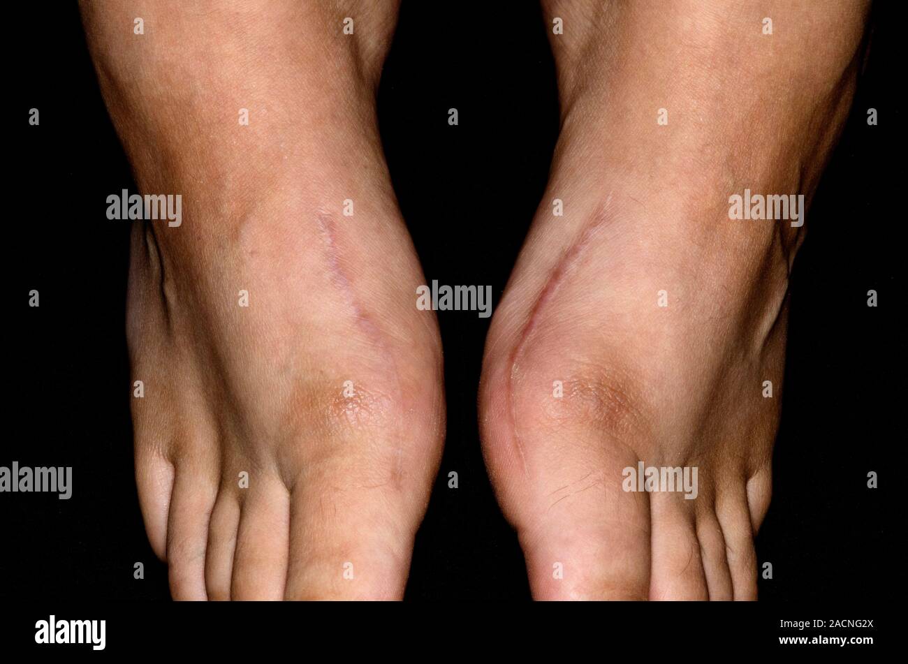 Bilateral scars on each foot in a 27 year old female patient after ...