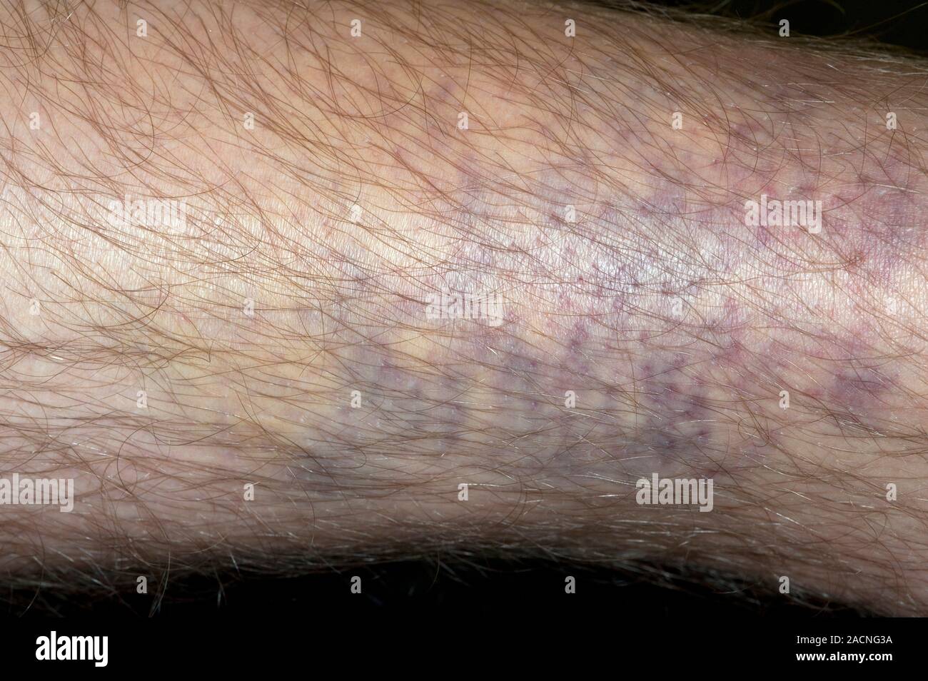 Bruising (haematoma) on the calf of the leg in a 22 year old male ...