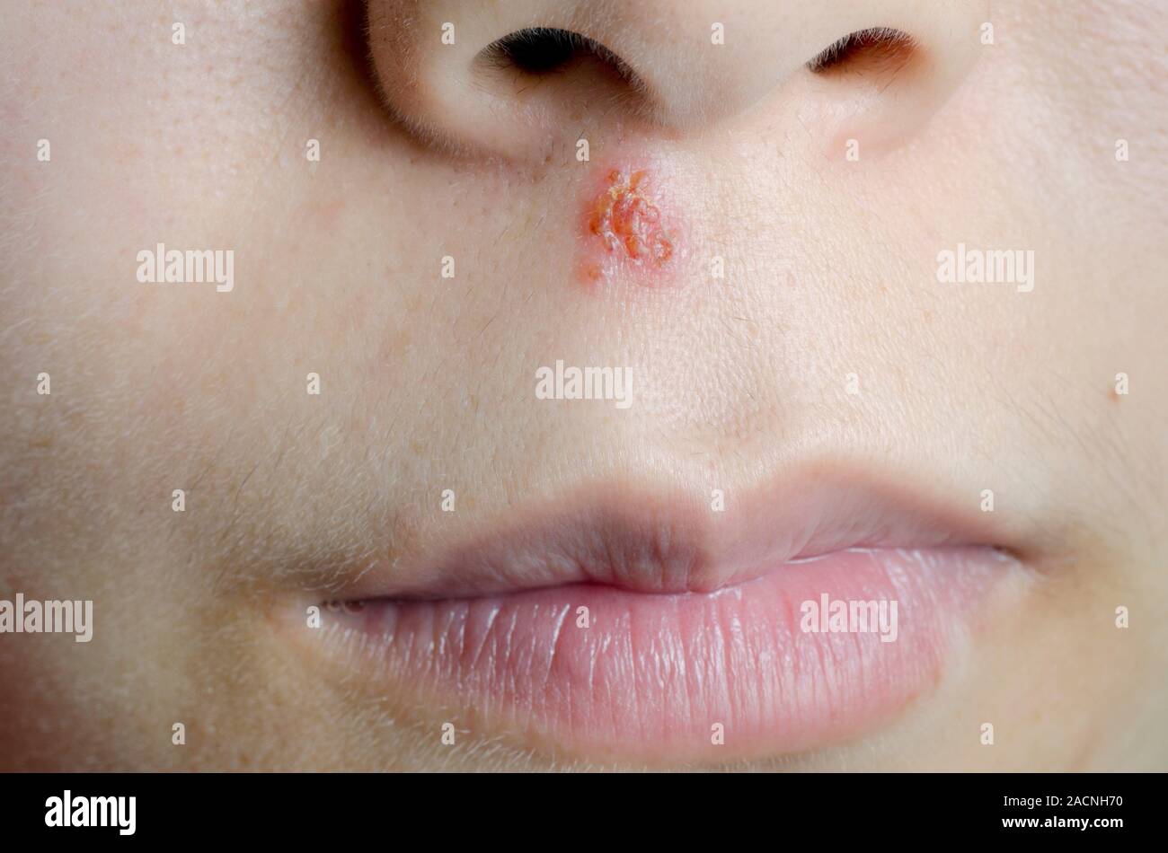 Cold sore. Close-up of a cold sore beneath the nose of a 27-year-old ...