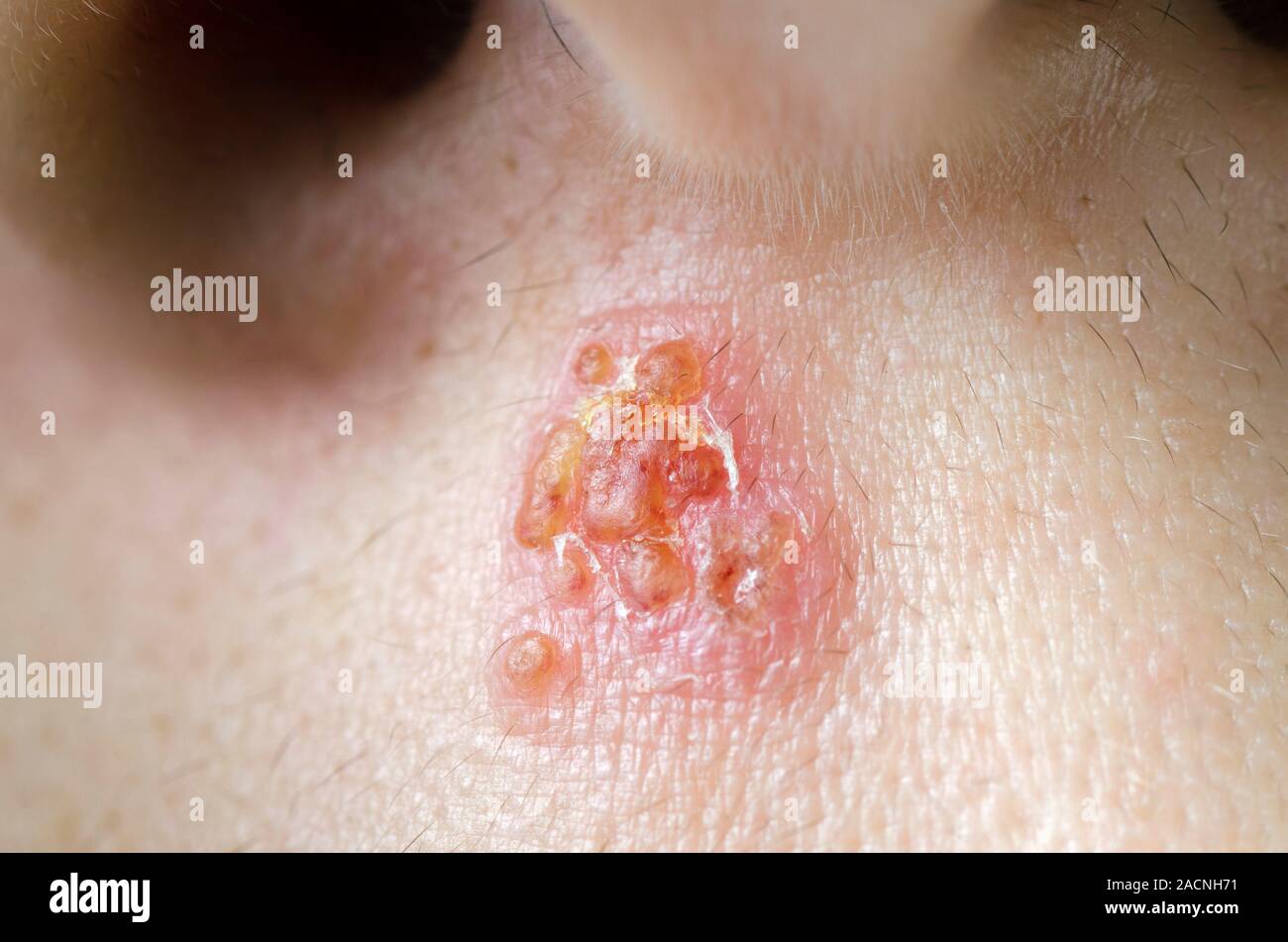 Cold sore. Close-up of a cold sore beneath the nose of a 27-year-old ...