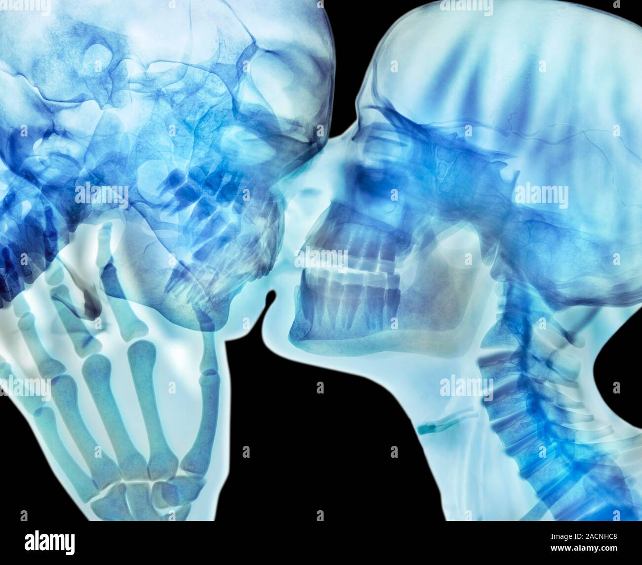 Lovers kissing, coloured X-ray Stock Photo - Alamy