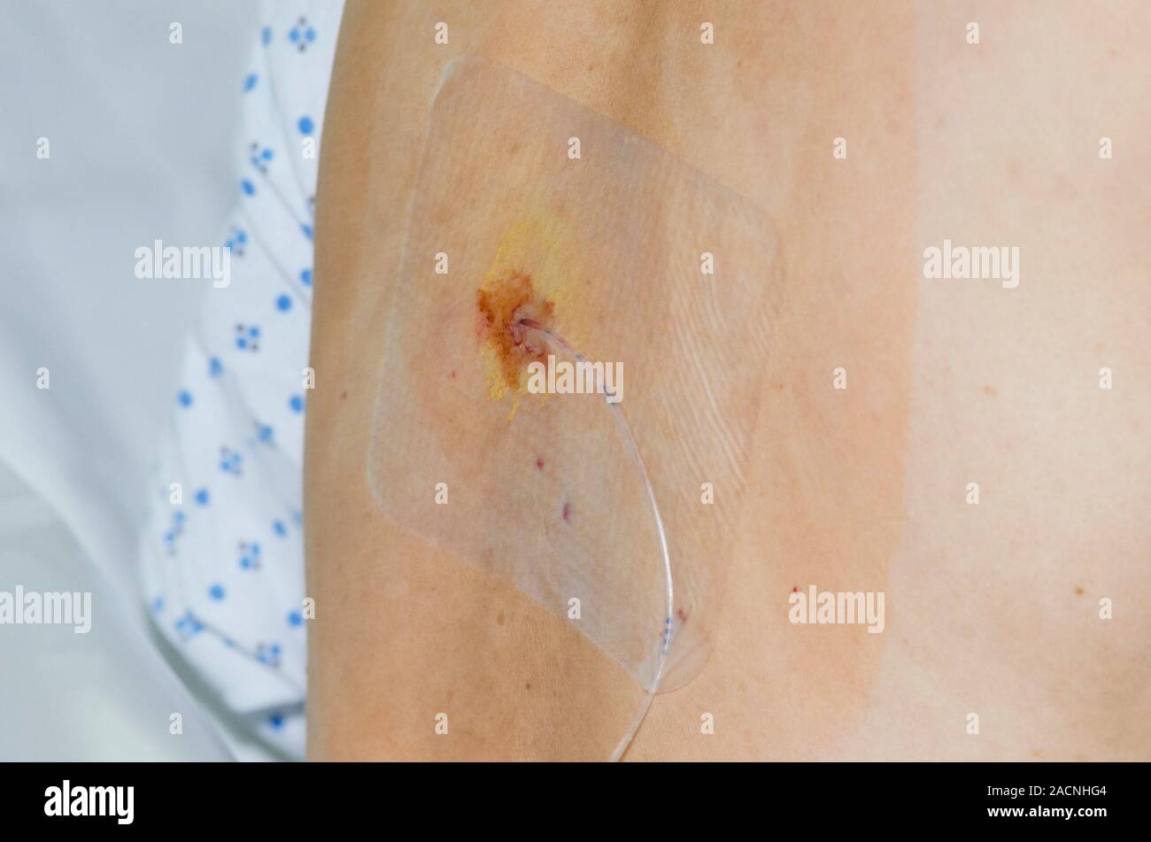Epidural anaesthetic. Line (tube) in a patient's back, through which an ...