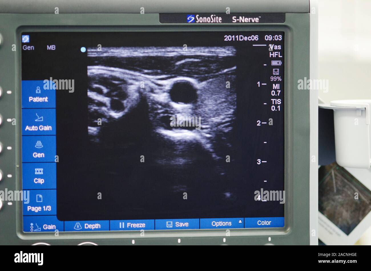 Central venous catheterisation. Ultrasound image of the neck of a ...
