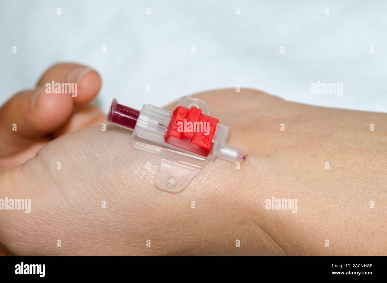 Arterial cannulation. Cannula inserted in a patient's radial artery ...