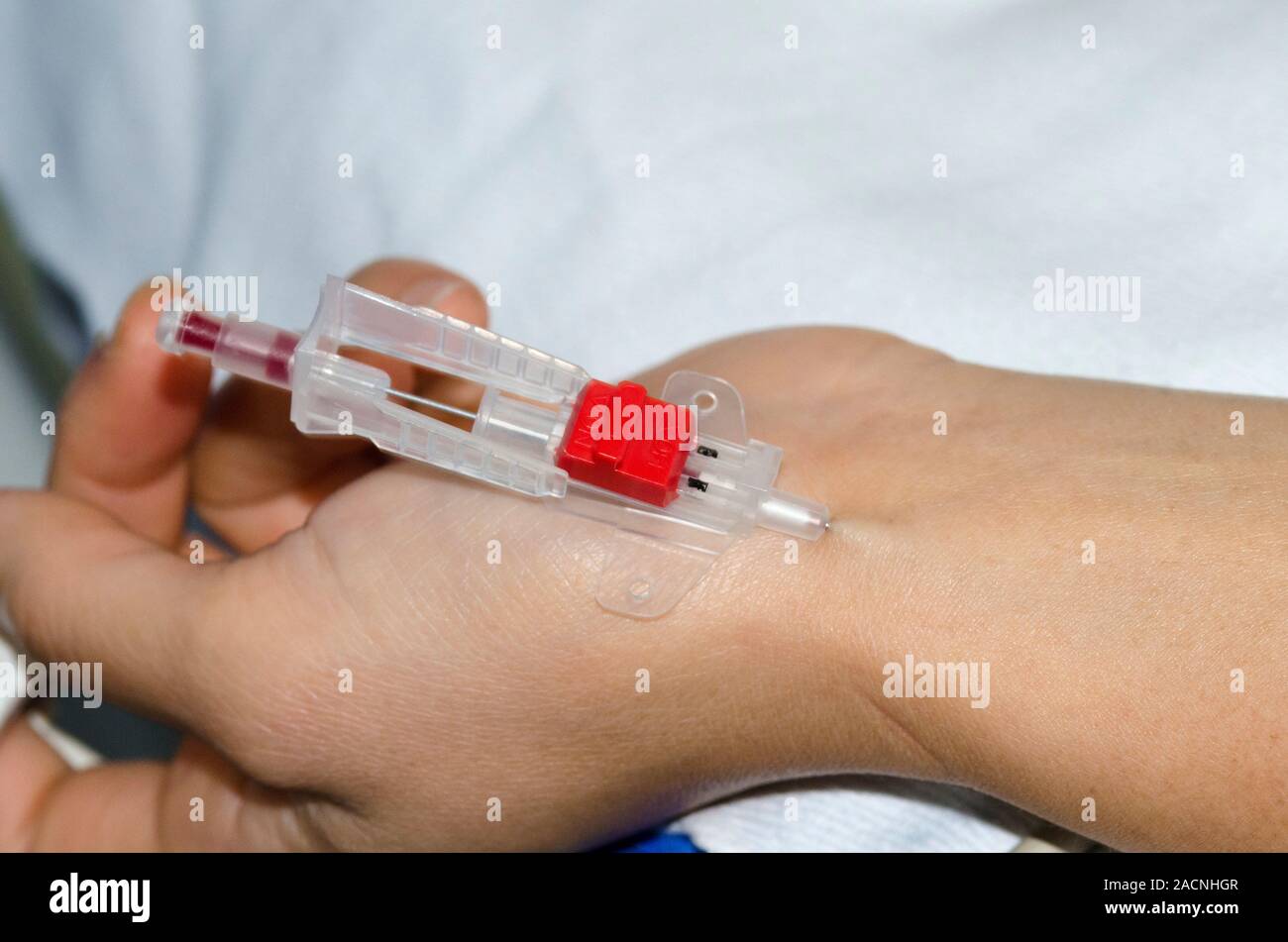 Arterial cannulation. Cannula inserted in a patient's radial artery ...