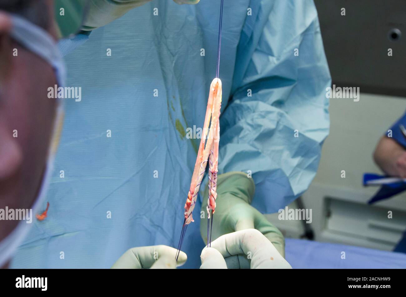 Knee ligament reconstruction surgery. Surgeon preparing a ligament ...