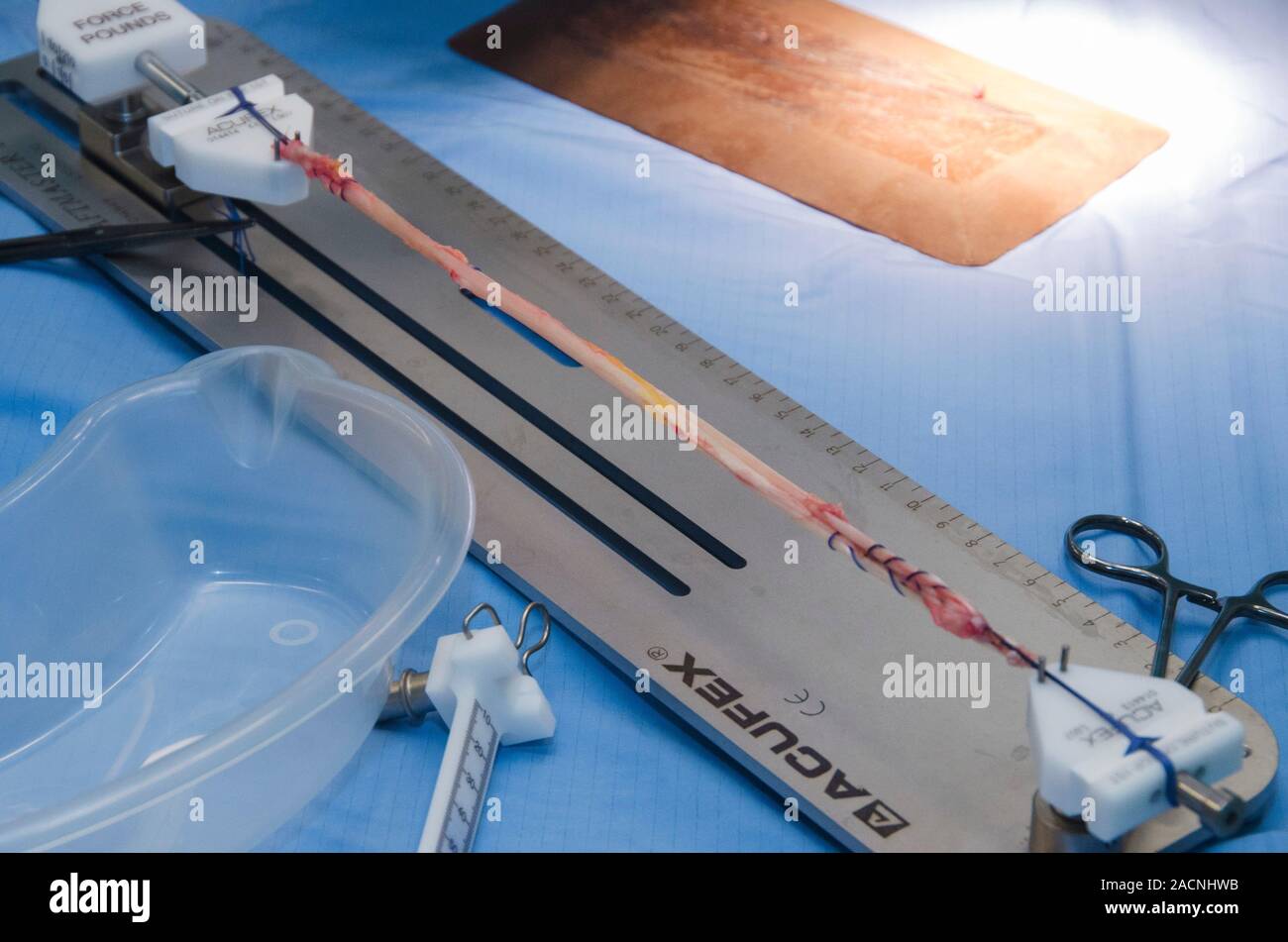 Knee ligament reconstruction surgery. Removed ligament being stretched ...