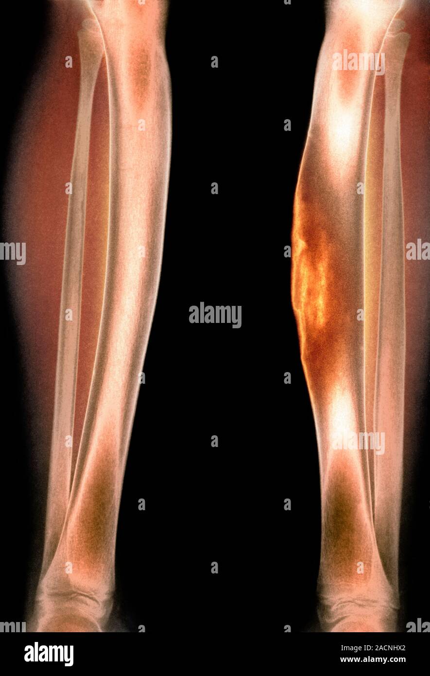 Congenital syphilis. Coloured X-ray of the lower legs of a child with ...