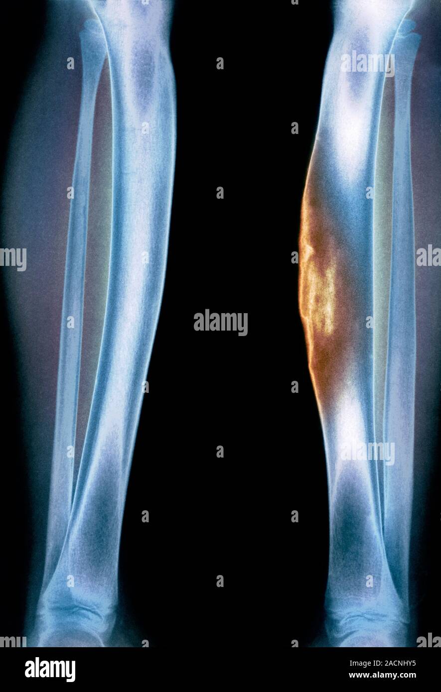 Congenital syphilis. Coloured X-ray of the lower legs of a child with ...