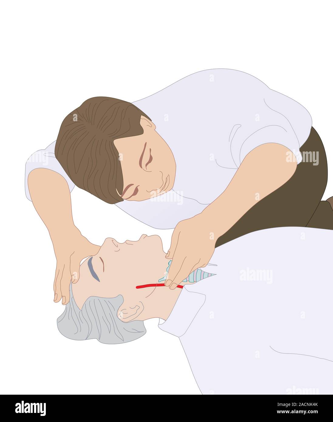 CPR first aid technique. Artwork showing the 5th of 6 steps used in the ...