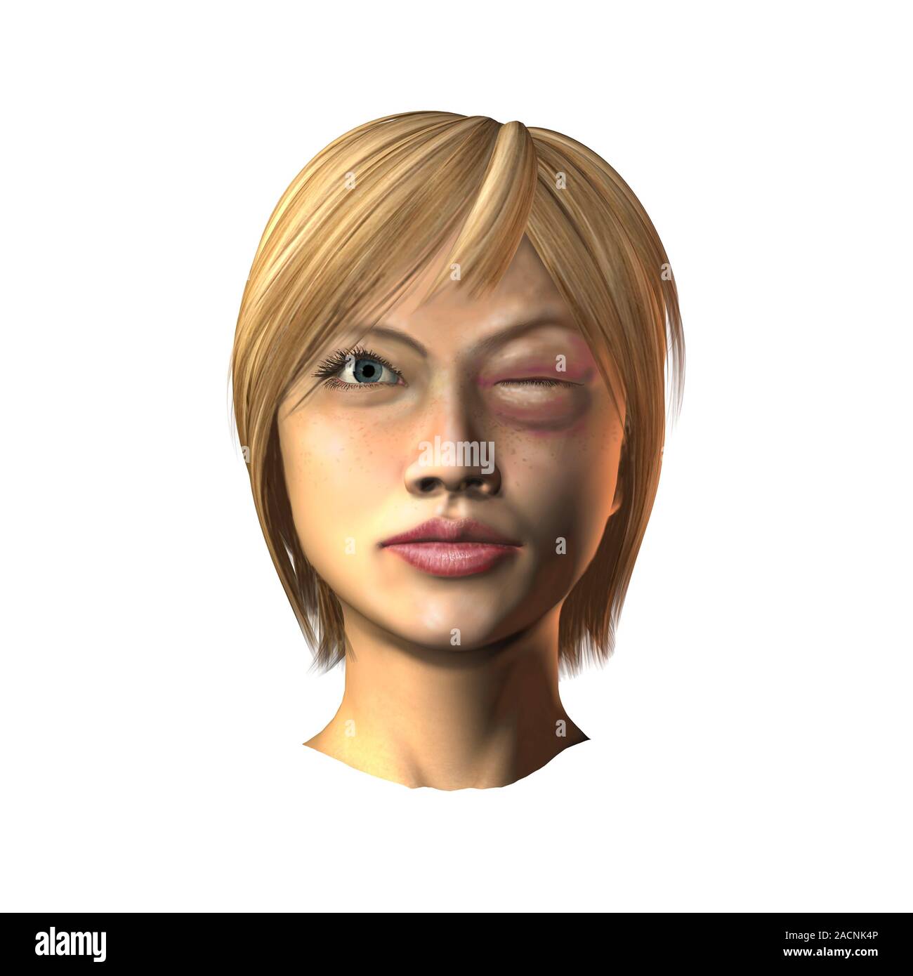 Plegmon eye inflammation. Artwork of a woman with a subcutaneous (below ...