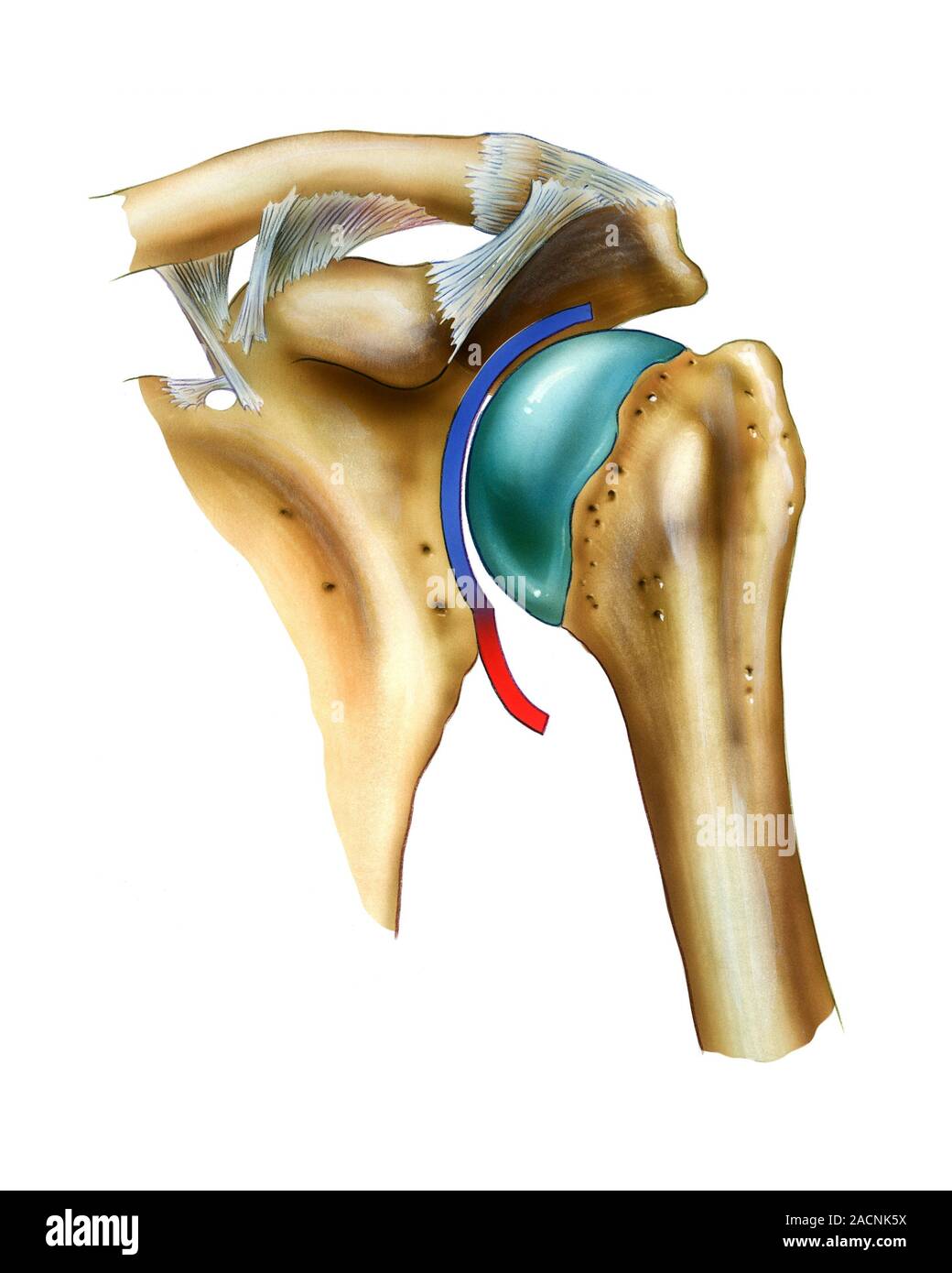 Infected shoulder capsule. Artwork showing an infection of the capsule ...