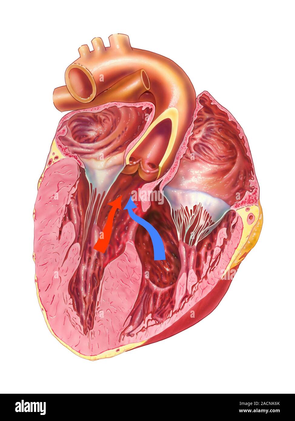 Heart chamber wall defect. Artwork of a posterior (from behind) view of ...