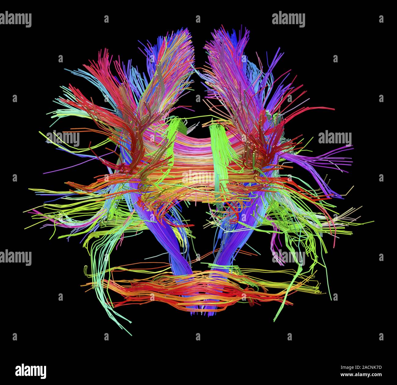 White matter fibres. Coloured 3D diffusion spectral imaging (DSI) scan ...