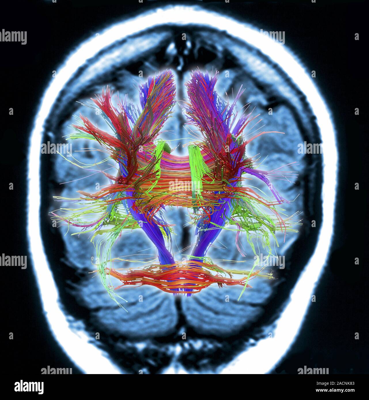 White matter fibres overlaid a mri scan of the human head. Coloured 3D diffusion spectral ...