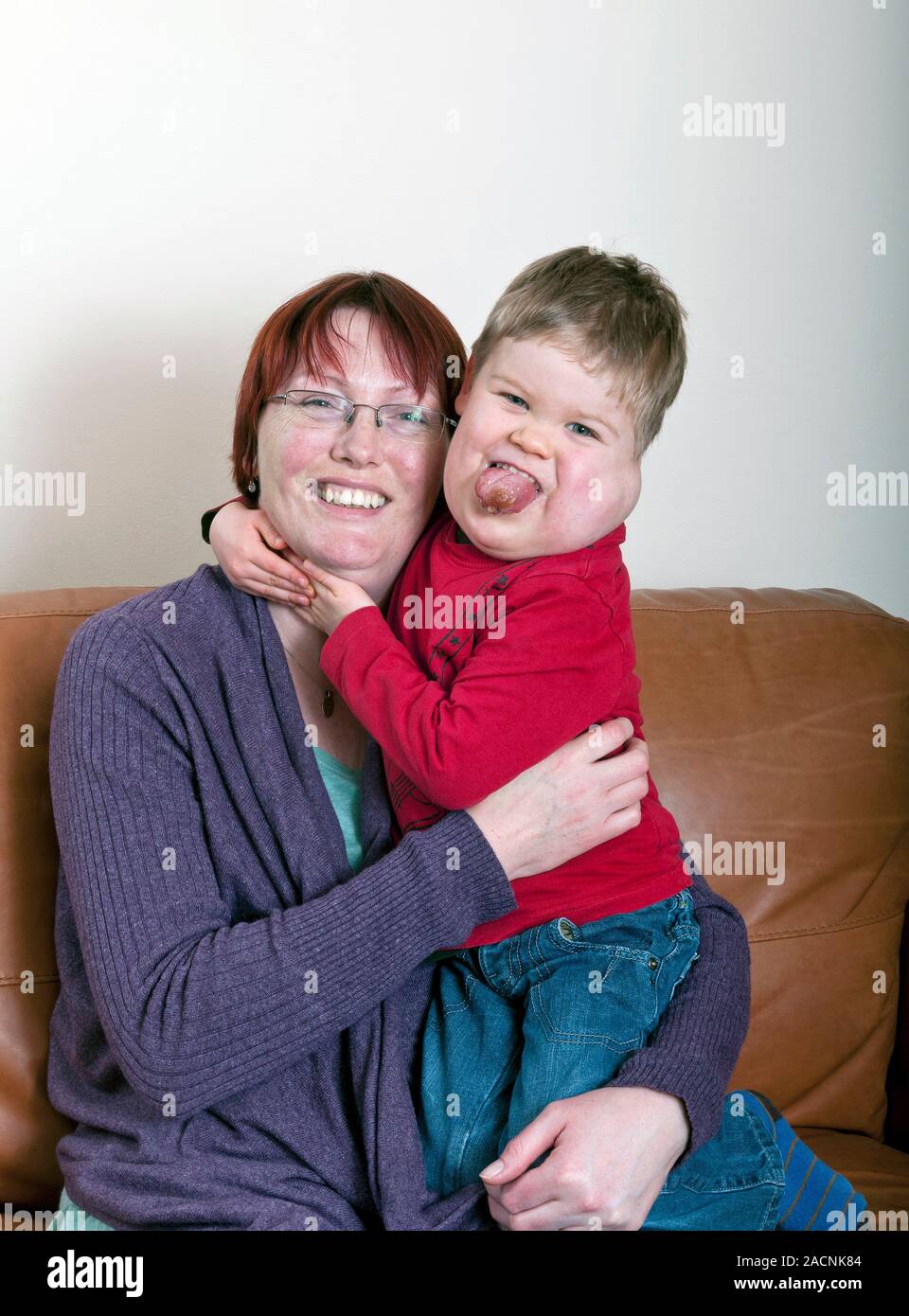 Cystic hygroma. A 3 year old boy with cystic hygroma, photographed with ...