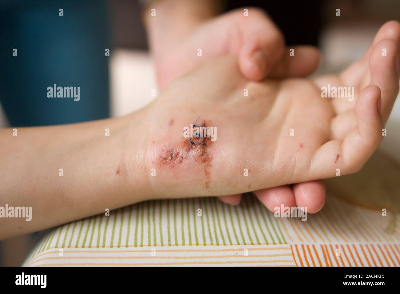View of a females hand injury which has stitches Stock Photo - Alamy