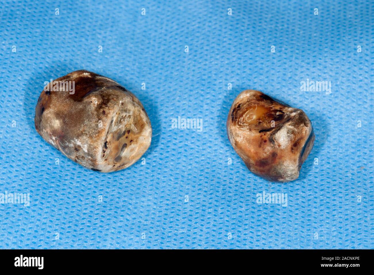 Gallstones removed during surgery. Gallstones (choleliths) are most ...