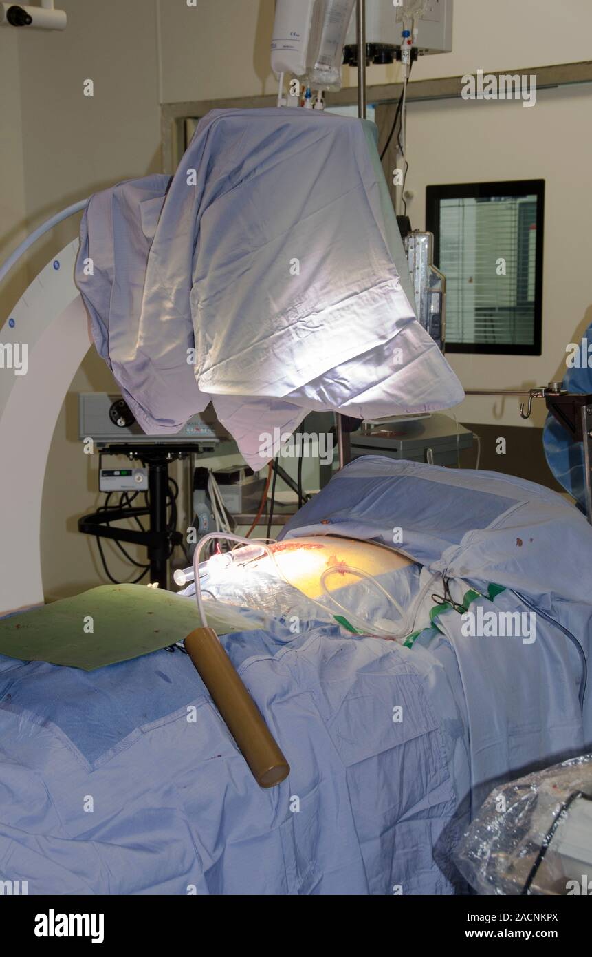 Gallstone surgery. X-ray machine positioned over a patient's abdomen ...