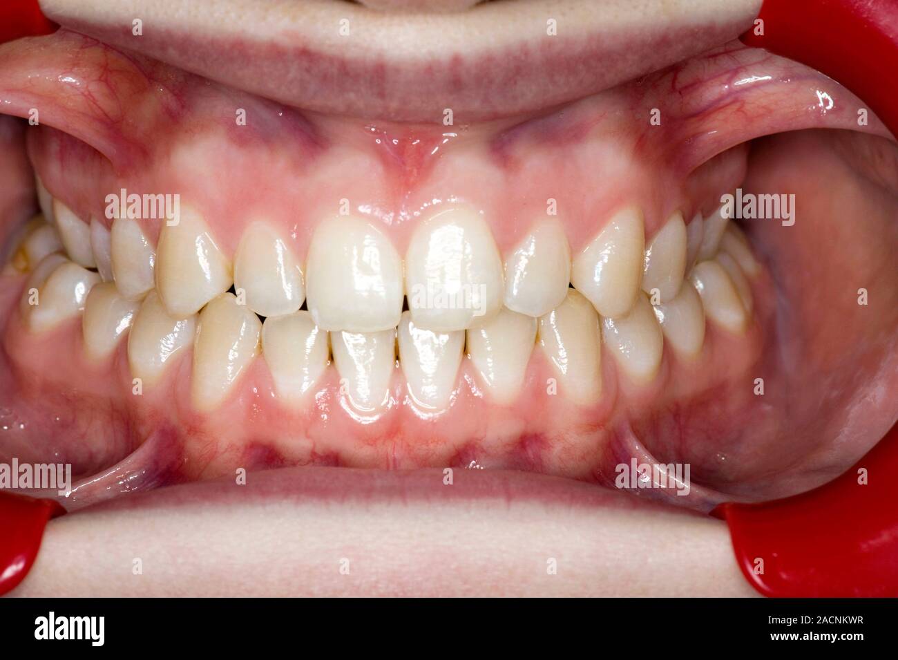 Healthy teeth. View inside the mouth of a healthy 21-year-old woman ...
