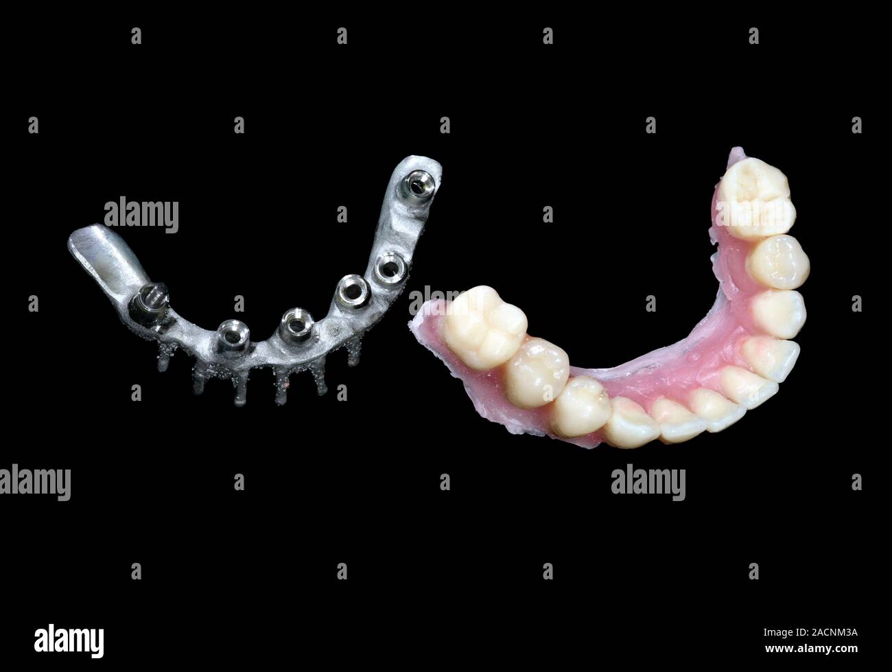 Dental prosthesis production. Metal frame (left) and dental prosthesis ...