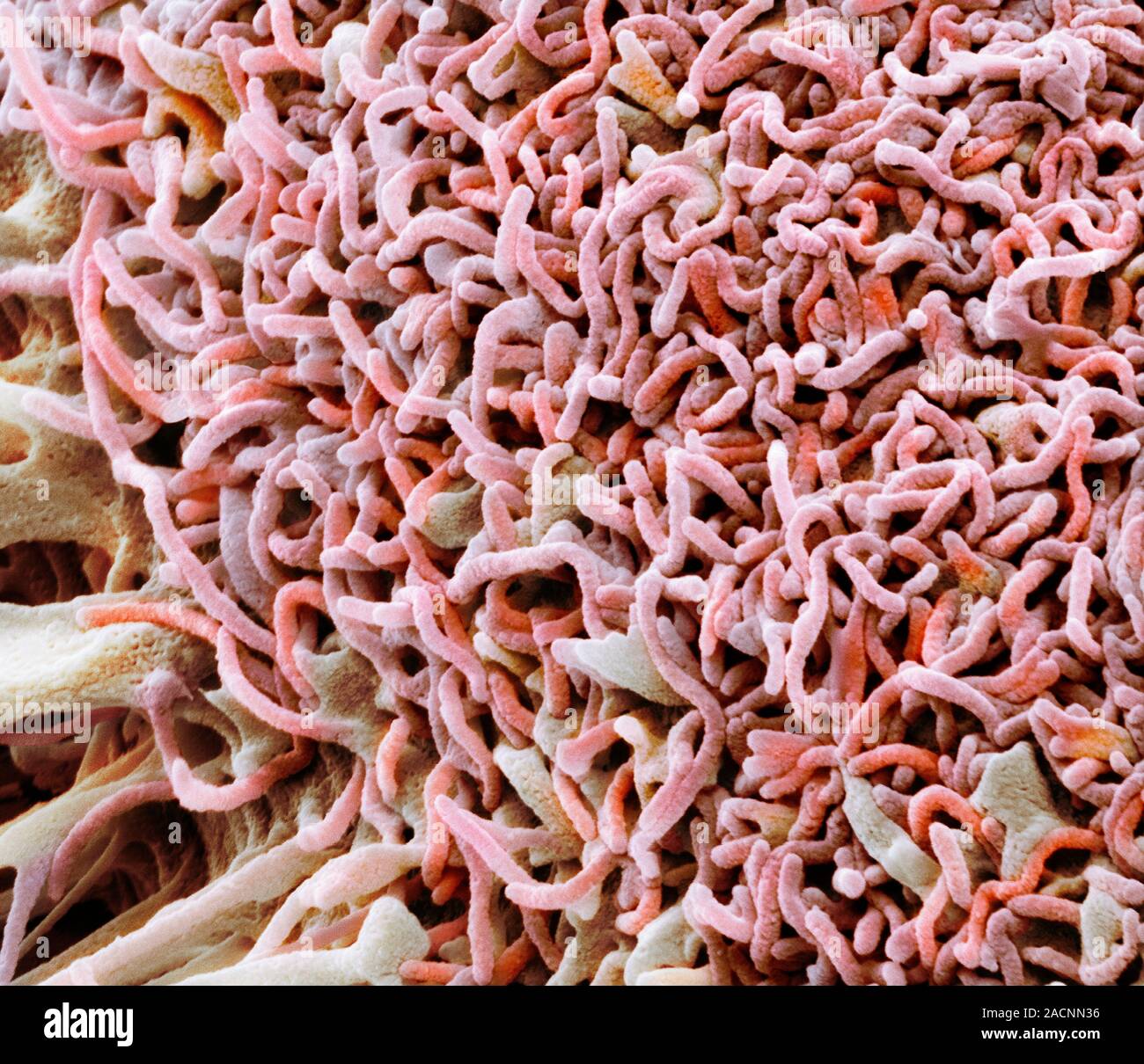 Mouth cancer cell. Coloured scanning electron micrograph (SEM) showing ...