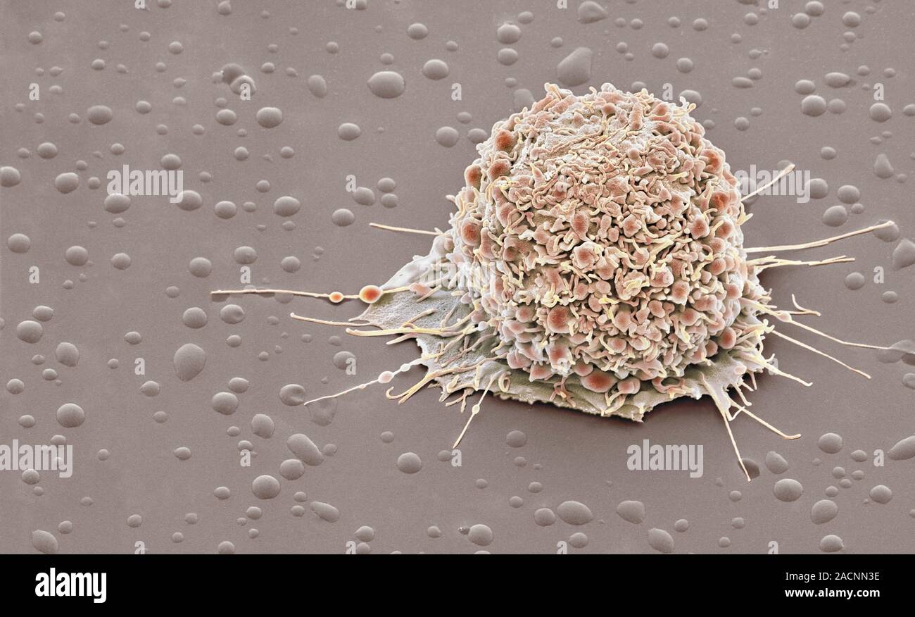 Mouth cancer cell. Coloured scanning electron micrograph (SEM) of a ...