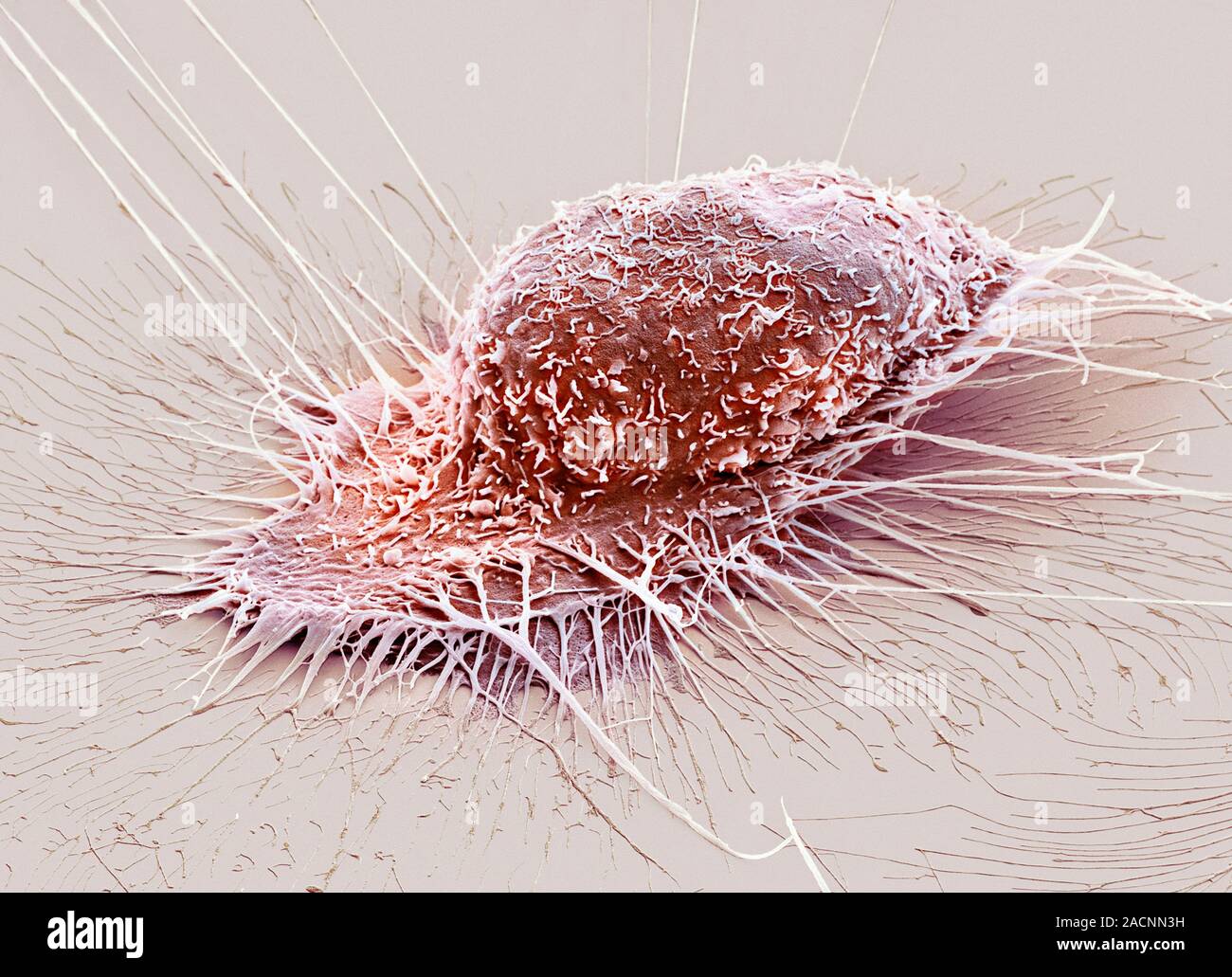 Mouth cancer cell. Coloured scanning electron micrograph (SEM) of a ...