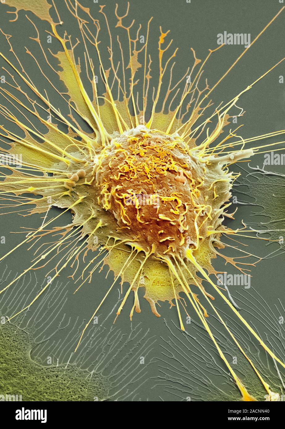 Mouth cancer cell. Coloured scanning electron micrograph (SEM) of a ...
