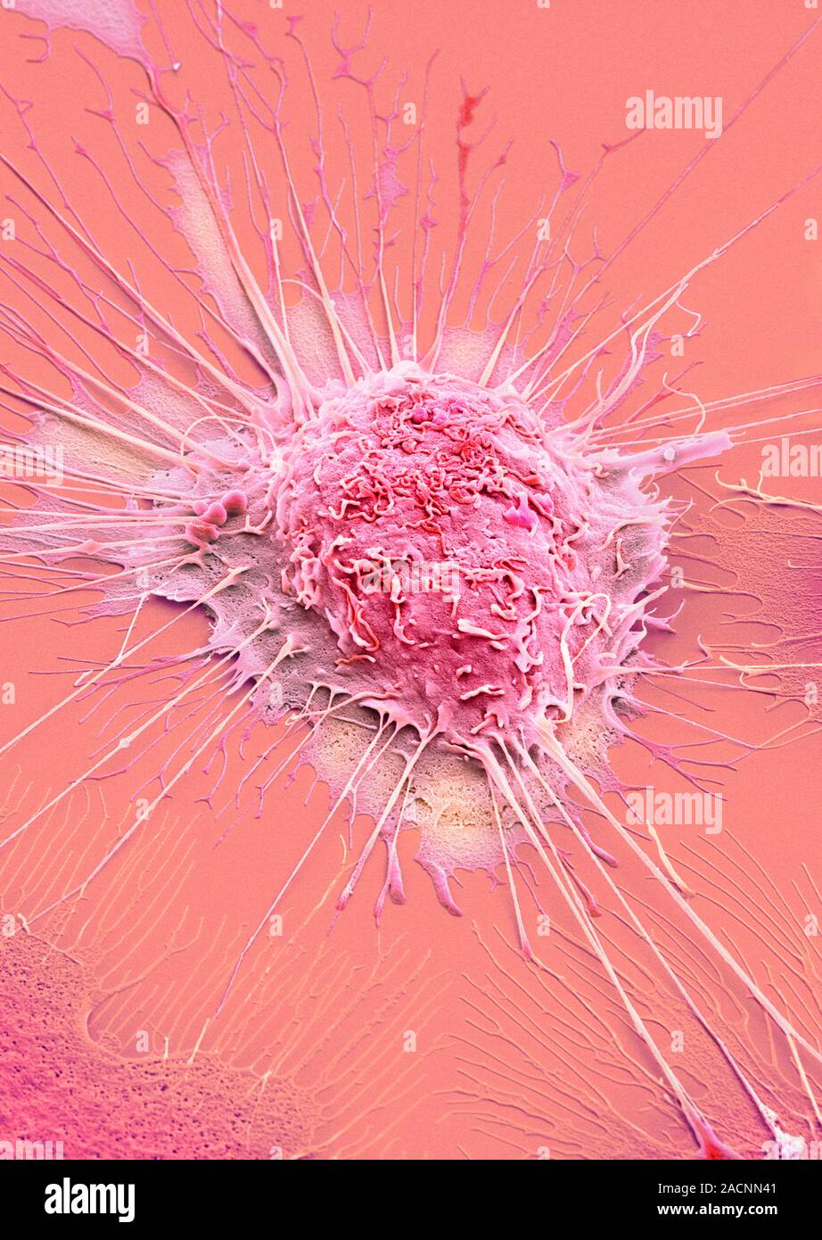 Mouth cancer cell. Coloured scanning electron micrograph (SEM) of a ...