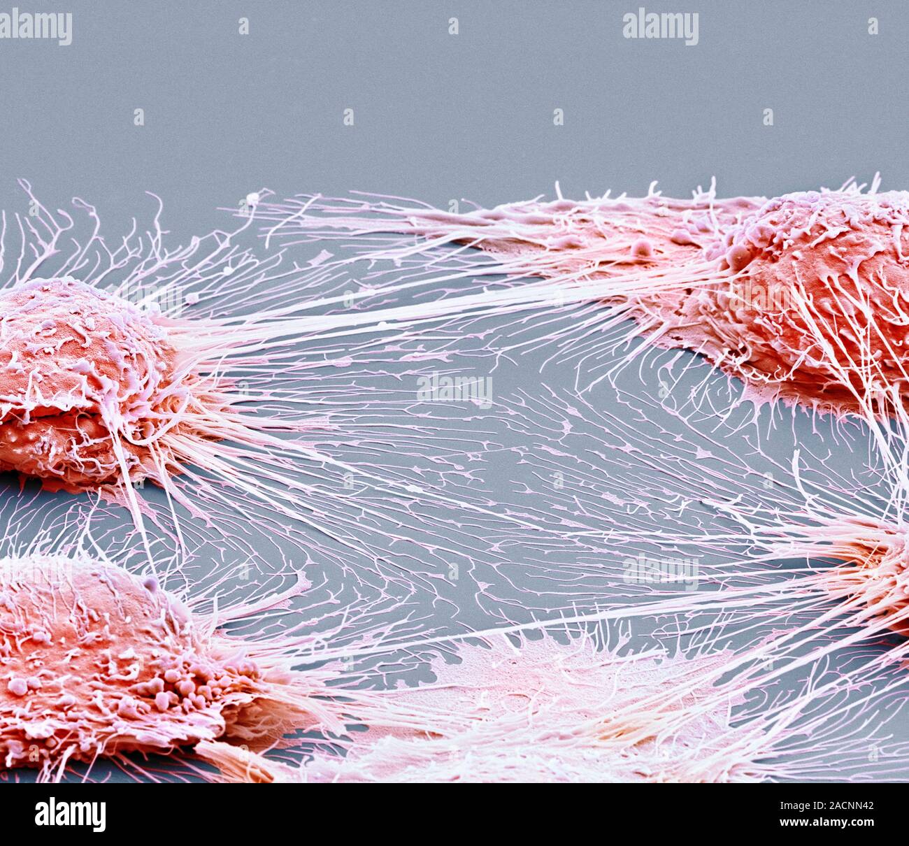 Mouth cancer cells. Coloured scanning electron micrograph (SEM) of ...