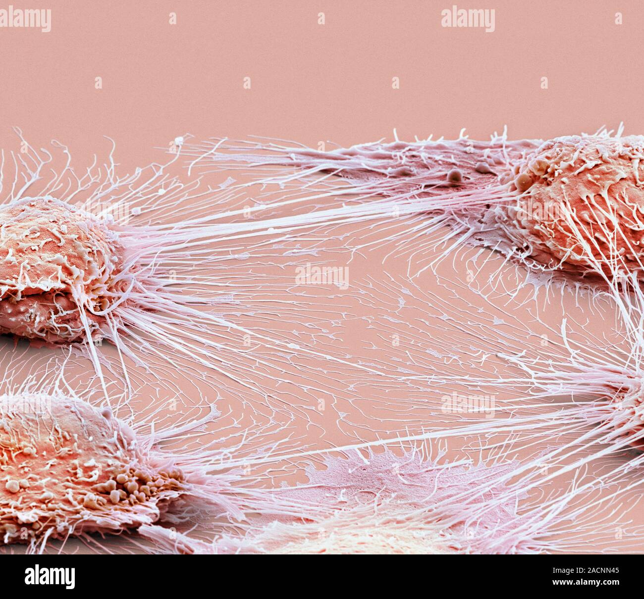 Mouth cancer cells. Coloured scanning electron micrograph (SEM) of ...